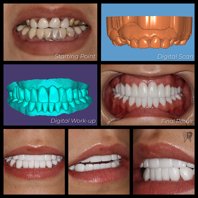 Smile Simulation with Digital Smile Design - Newport Beach Dental Studio